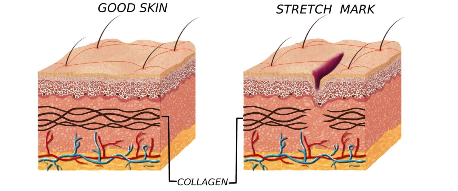 What Is Stretch Mark Camouflage Tattoo? | DAELA