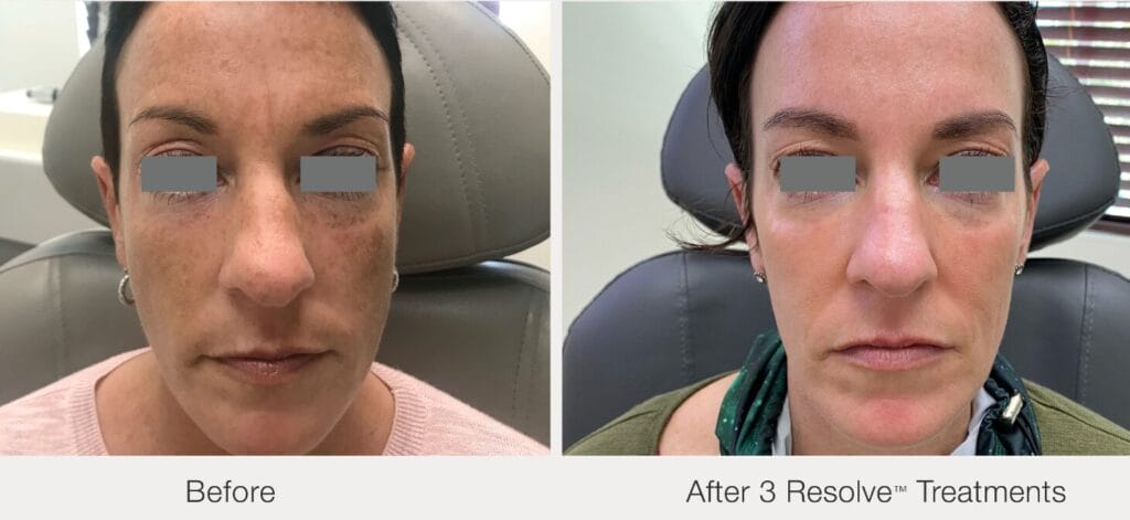 PicoWay Laser Tattoo Removal & Skin Treatments In Portland | DAELA