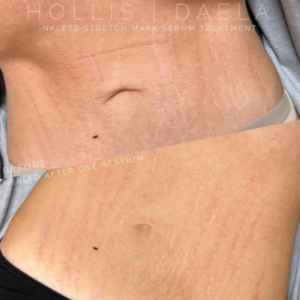 Scar Camouflage In Scottsdale | DAELA Cosmetic Tattoo