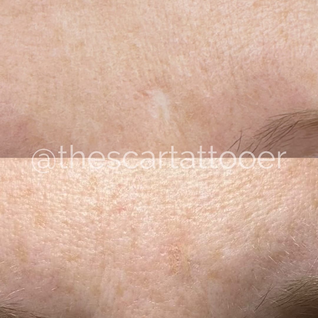 Stretch Mark Camouflage Treatments In Scottsdale | DAELA Cosmetic Tattoo