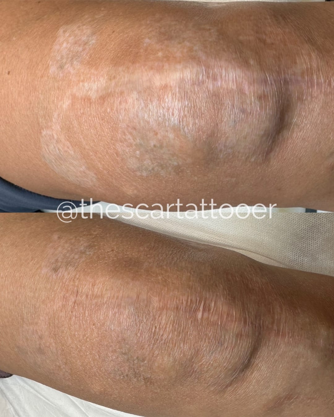 Scar Camouflage In Scottsdale | DAELA Cosmetic Tattoo
