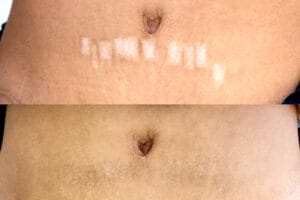 Scar Camouflage Tattoo: What It Is, How It Works & The Benefits
