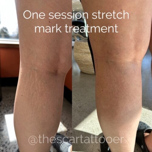 The Best Time For Stretch Mark Camouflage | DAELA