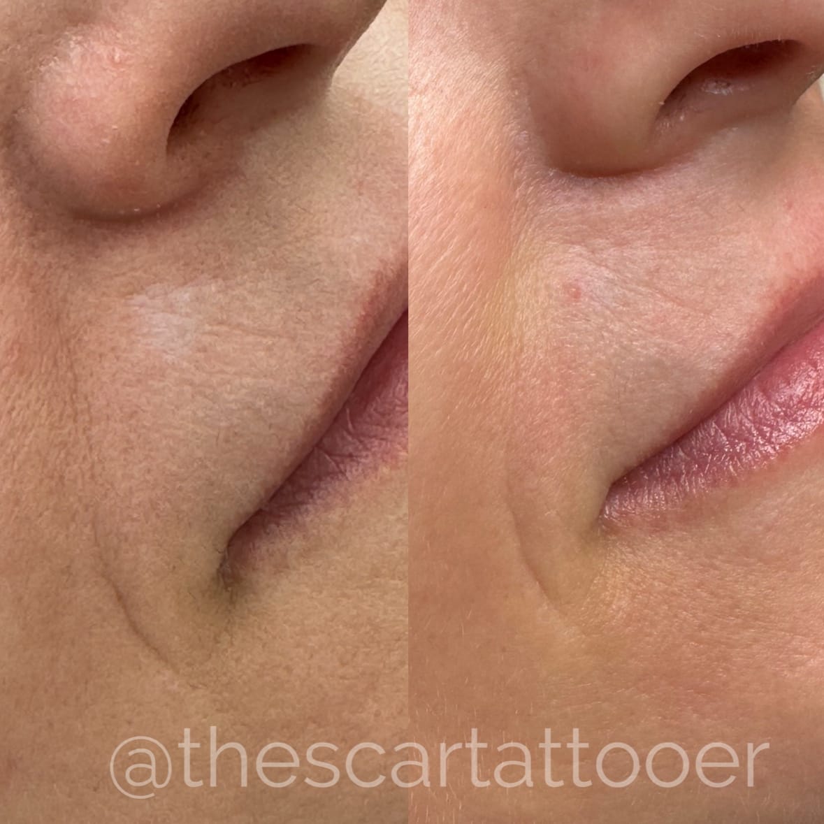 Hide Scars On Your Lip! Powerful Way To Conceal Scars!