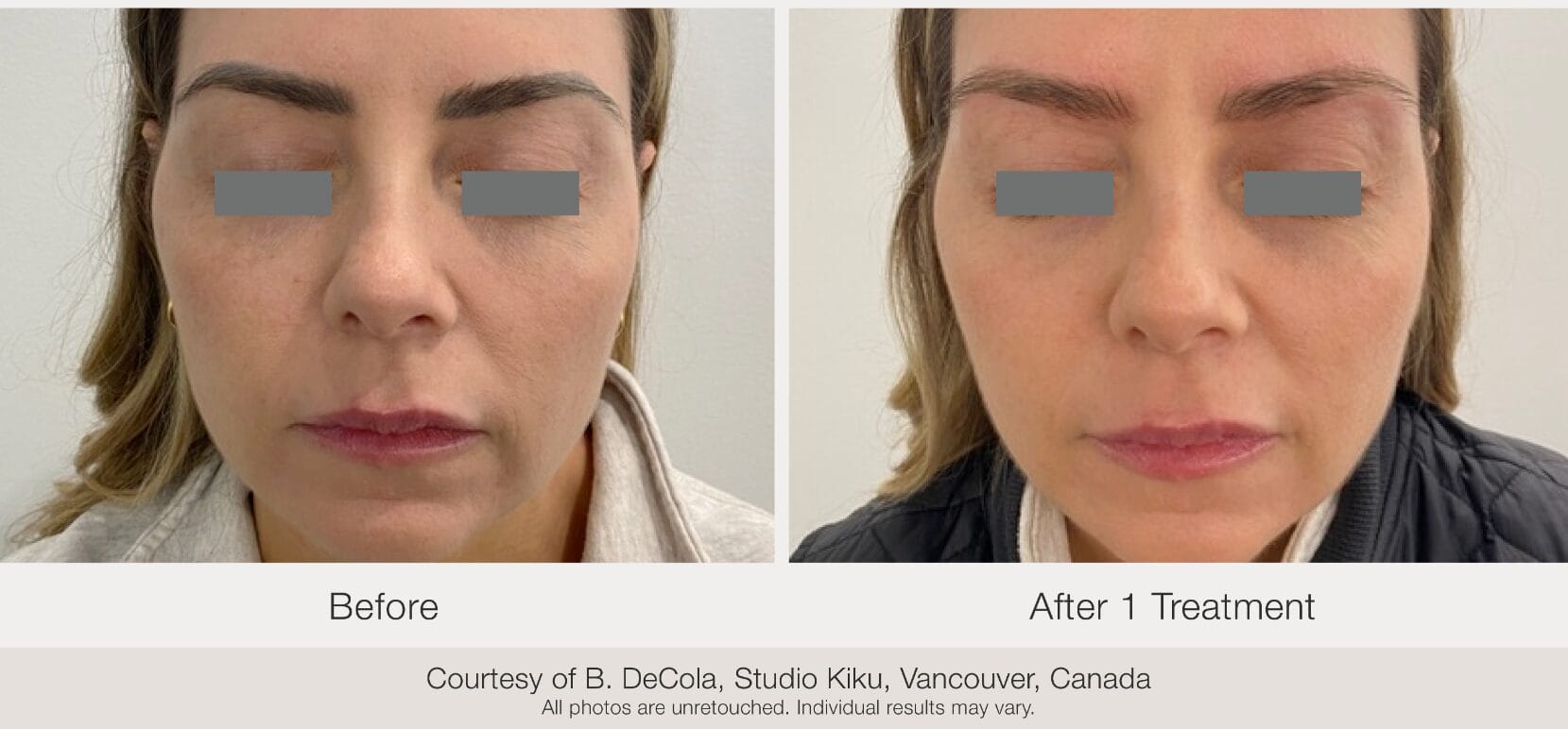Permanent Makeup Removal: How It Works, Benefits & More | DAELA
