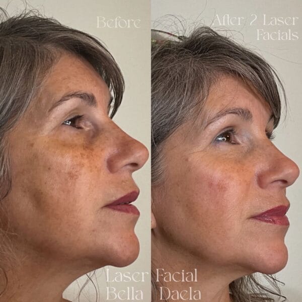 Glow Up With Laser Skin Treatments: The Secret To Radiant, Youthful ...
