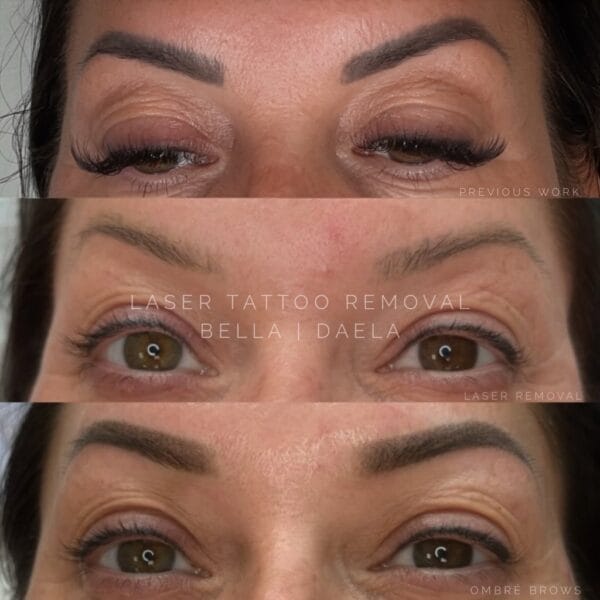 Permanent Brow Makeup Removal | DAELA