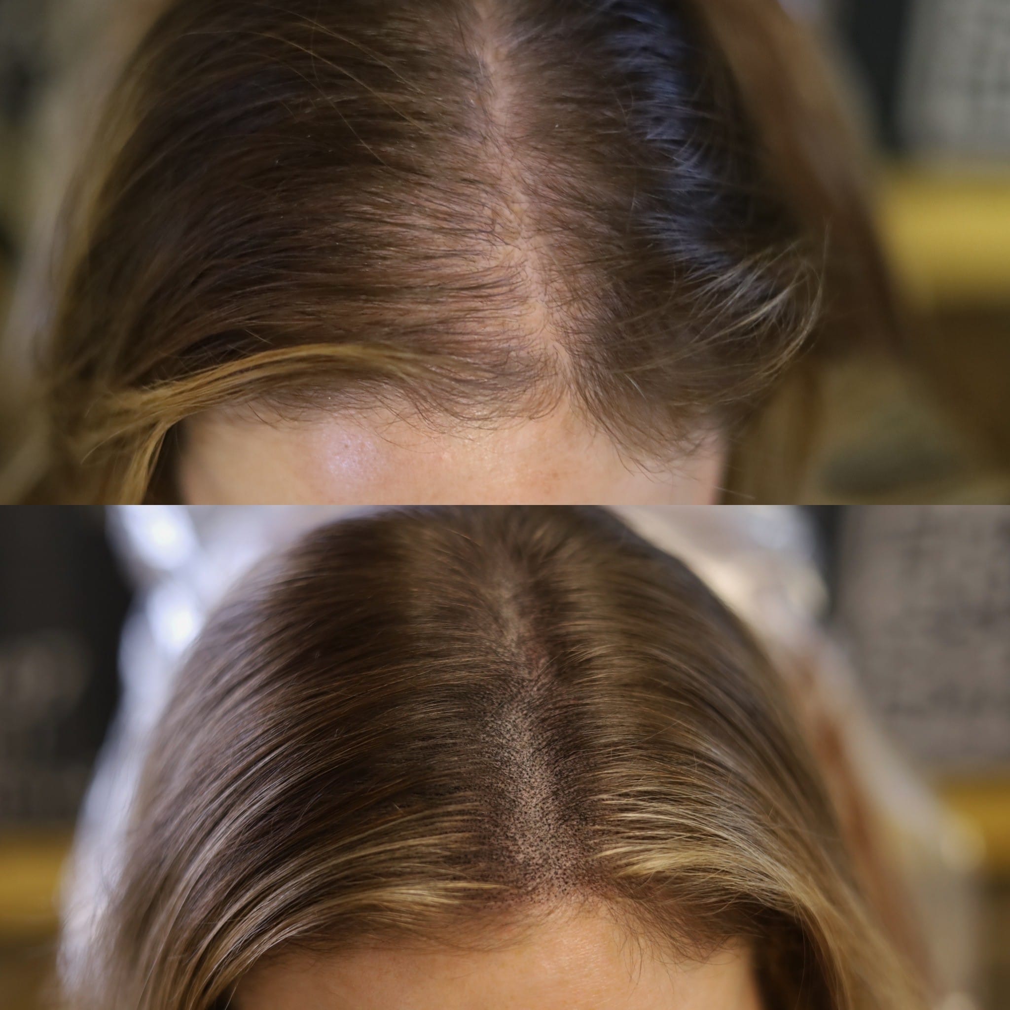 Scalp Micropigmentation: How It Works, Benefits & More | DAELA