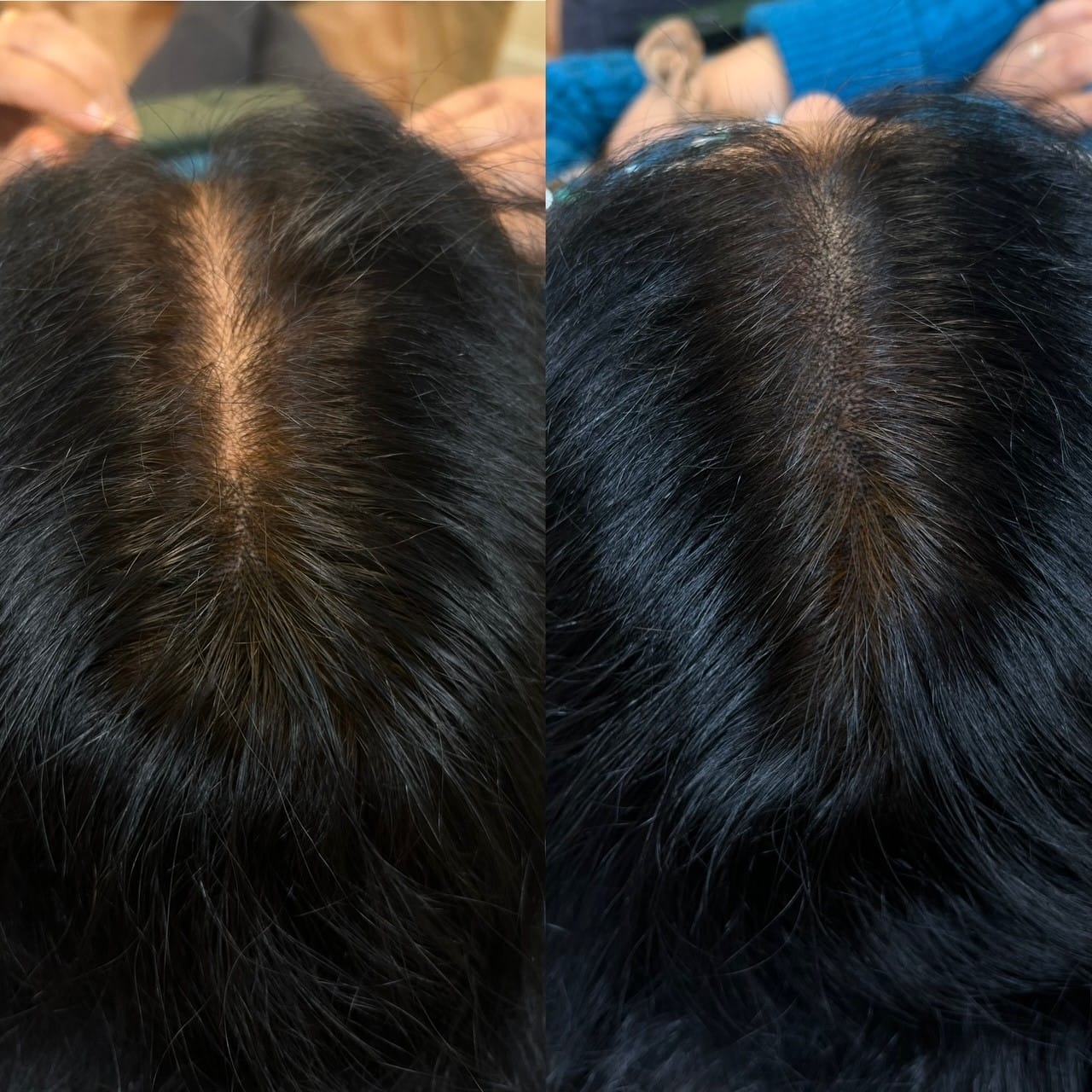 Scalp Micropigmentation: How It Works, Benefits & More | DAELA
