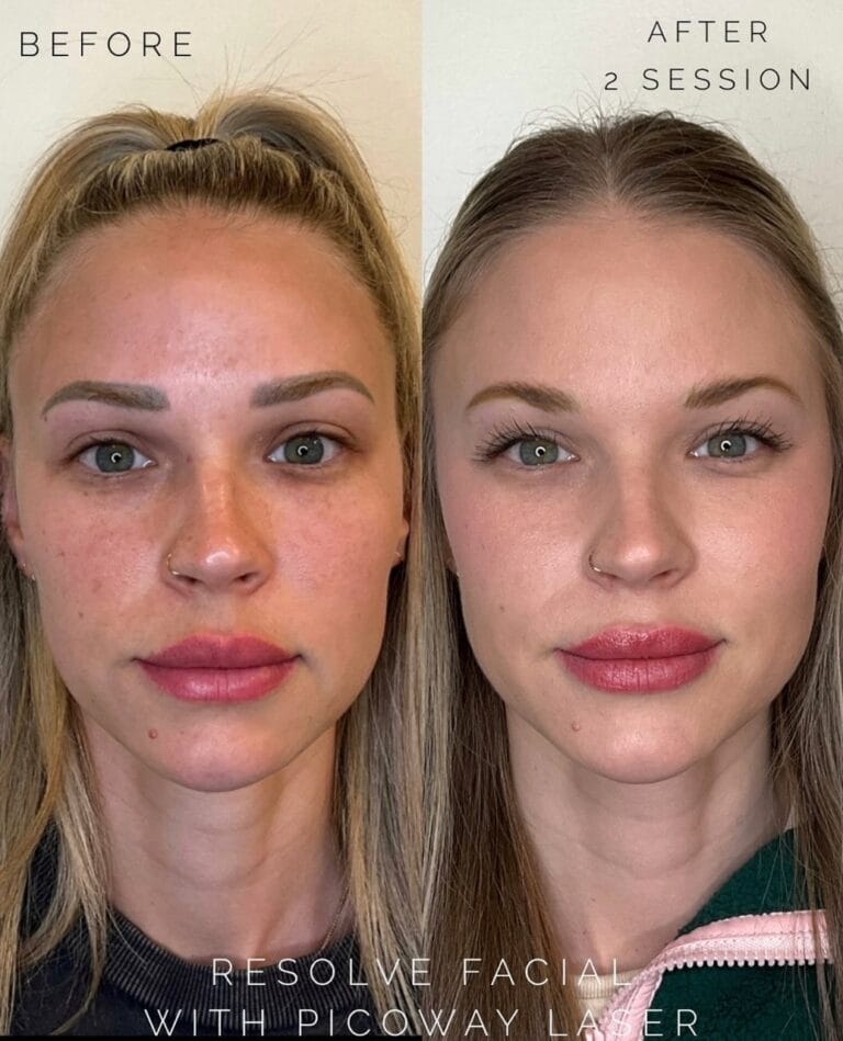 The Top 10 Questions About PicoWay® Resolve Laser Skin Treatments ...