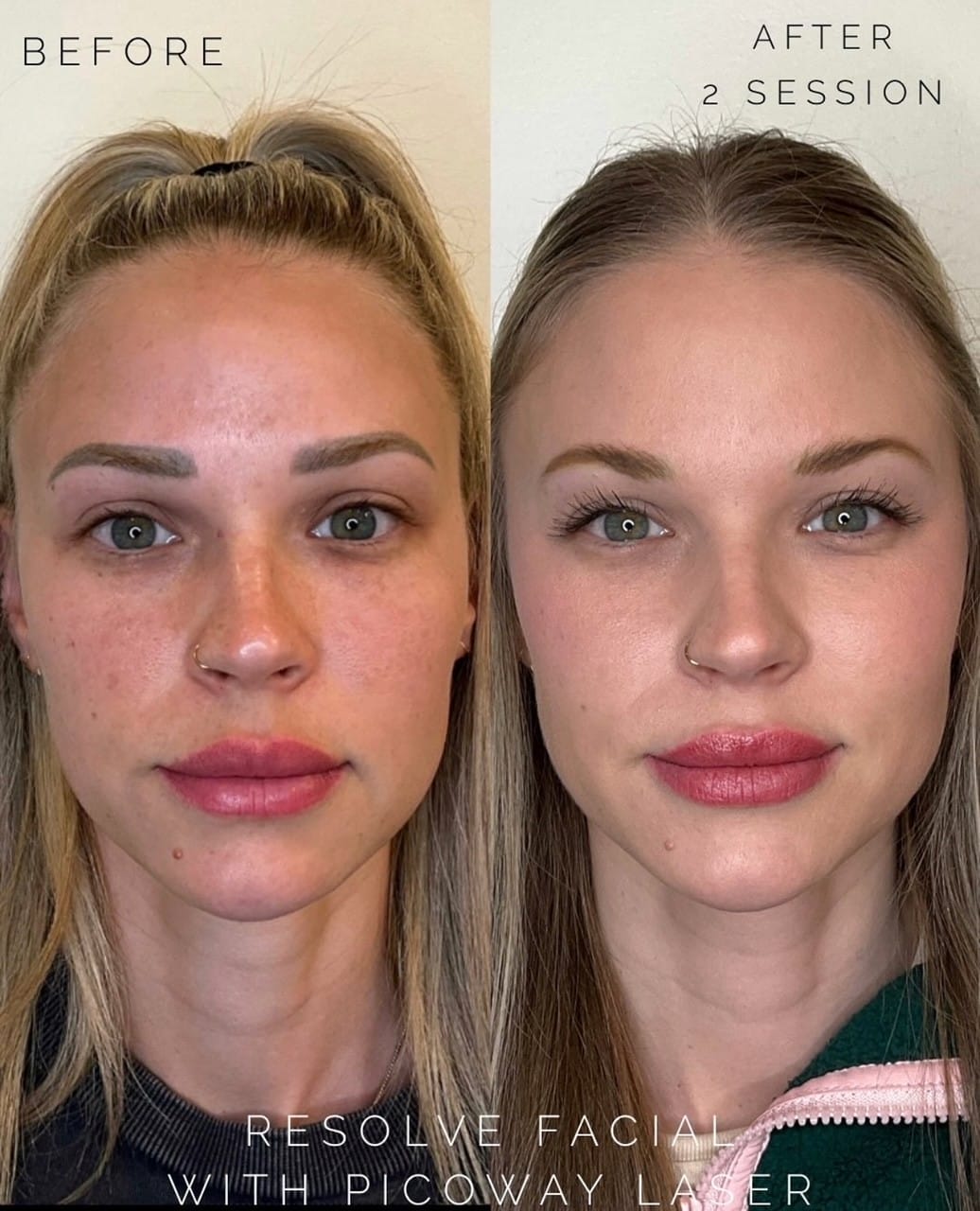 The Top 10 Questions About PicoWay® Resolve Laser Skin Treatments ...