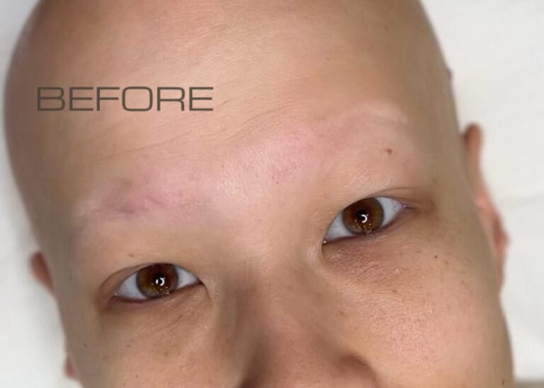 Why Nano Machine Brows Are The Best Solution For Alopecia | DAELA