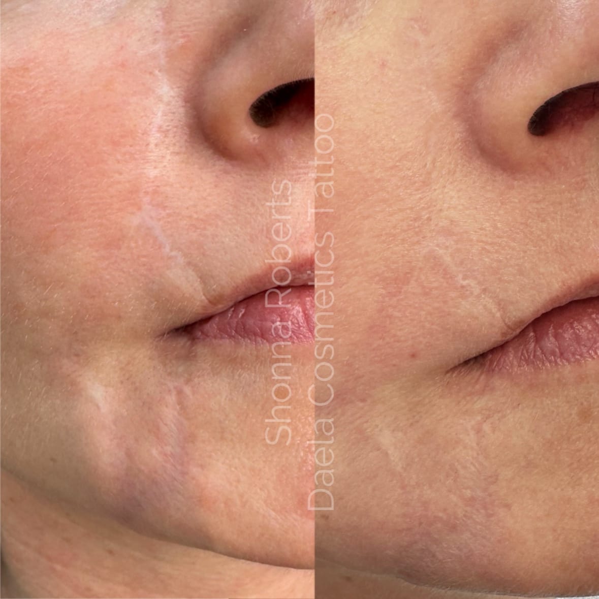 Scar Camouflage Tattoo Training: How It Works, Benefits & More | DAELA