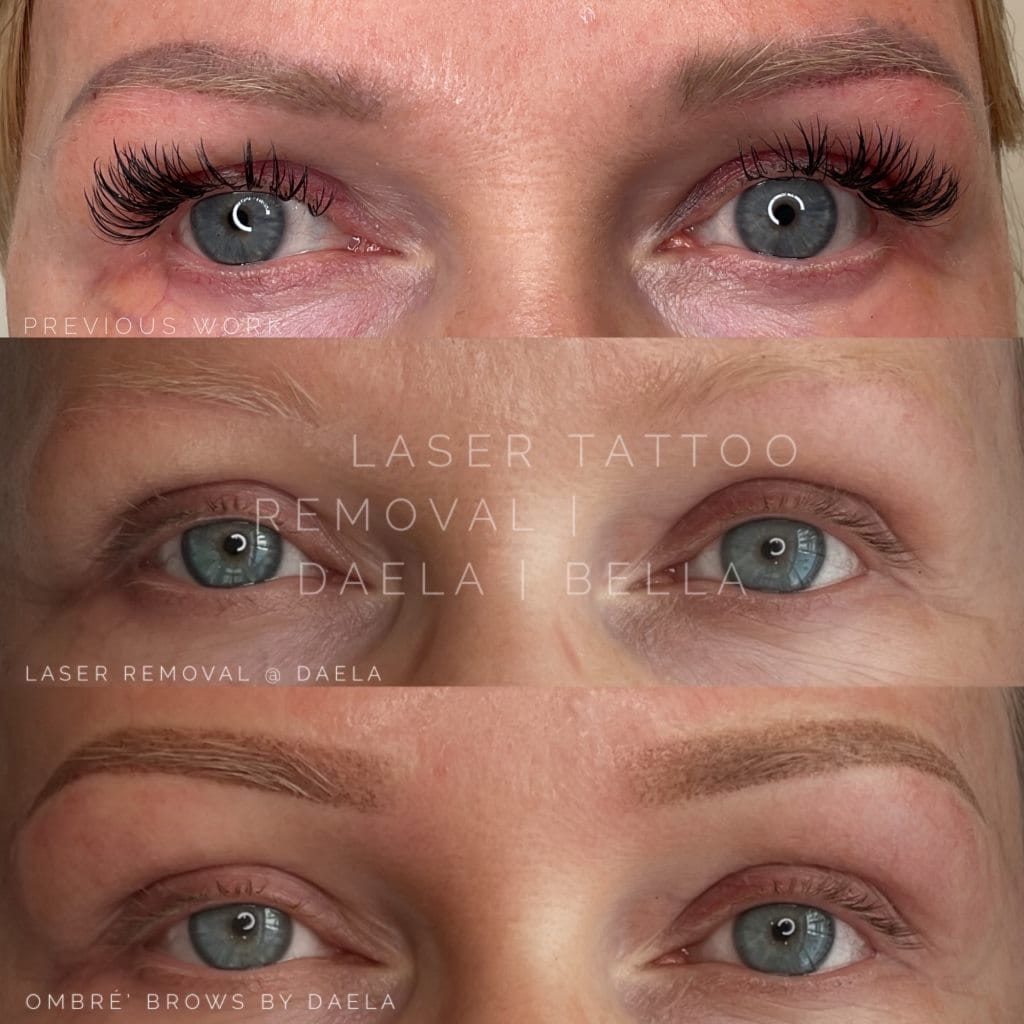 Why Microneedling Between Brow Tattoo Removal Sessions Works | DAELA