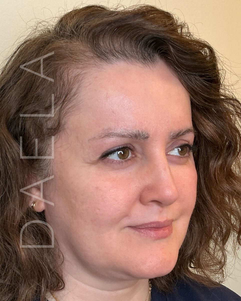 Microneedling For Fuller, Natural Brows | DAELA