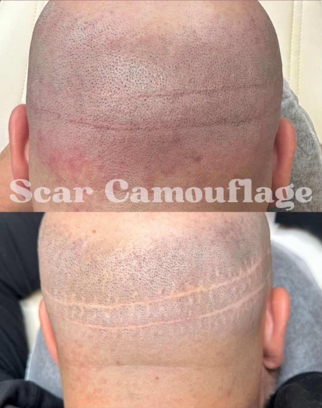 How SMP Conceals Hair Transplant Scars And Restores Confidence | DAELA