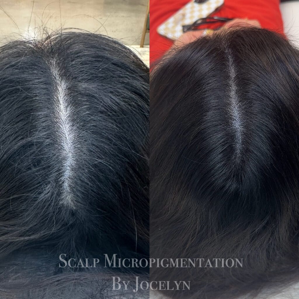 Comprehensive Guide To Scalp Micropigmentation | DAELA