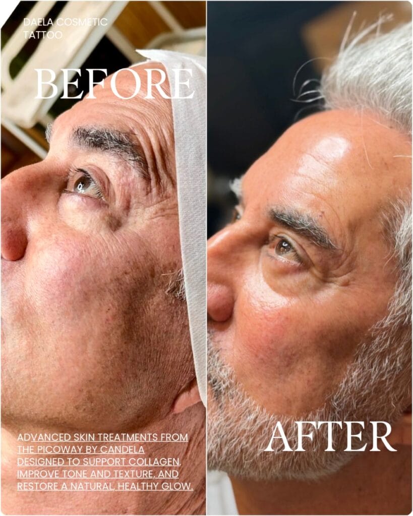 Laser Skin Treatments For Men: Brown Spot Removal | DAELA
